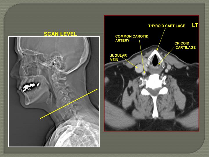 PPT - CT NECK PowerPoint Presentation - ID:2036160