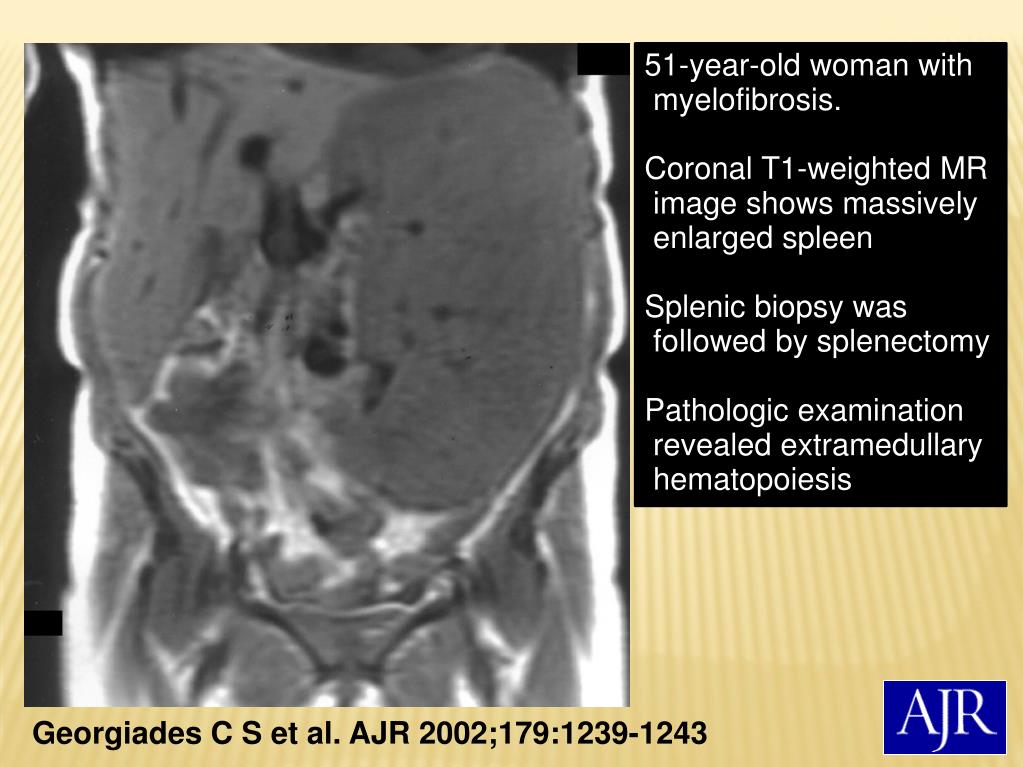 Myelofibrosis Mri