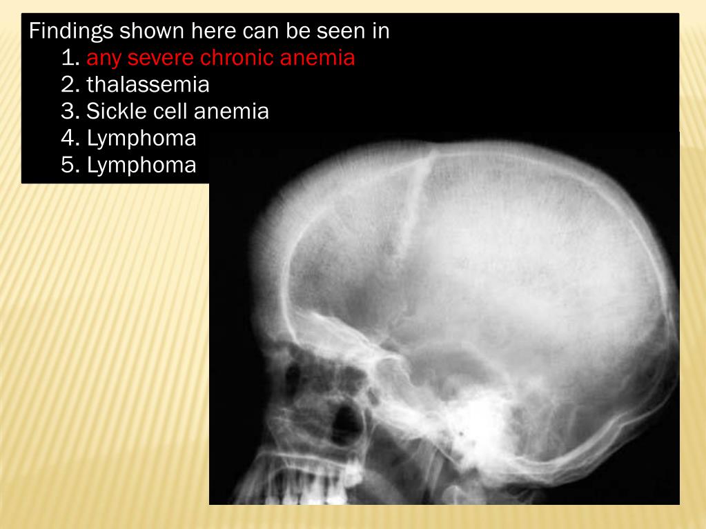 PPT - RADIOLOGY of HEMATOPOIETIC DISORDERS DR. SAJJAD HUSSAIN ASSISTANT ...