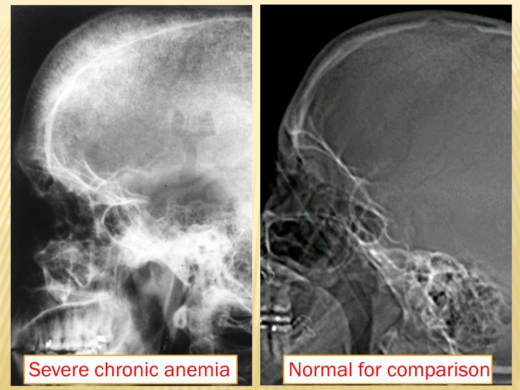 PPT - RADIOLOGY of HEMATOPOIETIC DISORDERS DR. SAJJAD HUSSAIN ASSISTANT ...