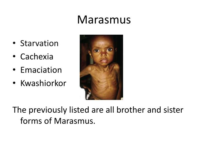 PPT - Marasmus PowerPoint Presentation - ID:2037853