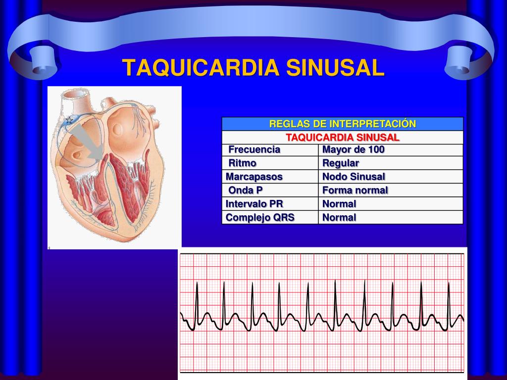 Taquicardia Ventricular Paroxistica