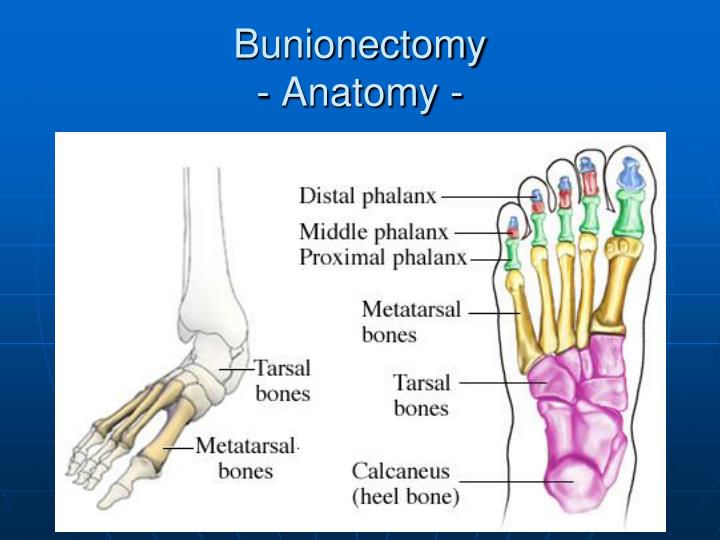 PPT - Bunionectomy PowerPoint Presentation - ID:2041227