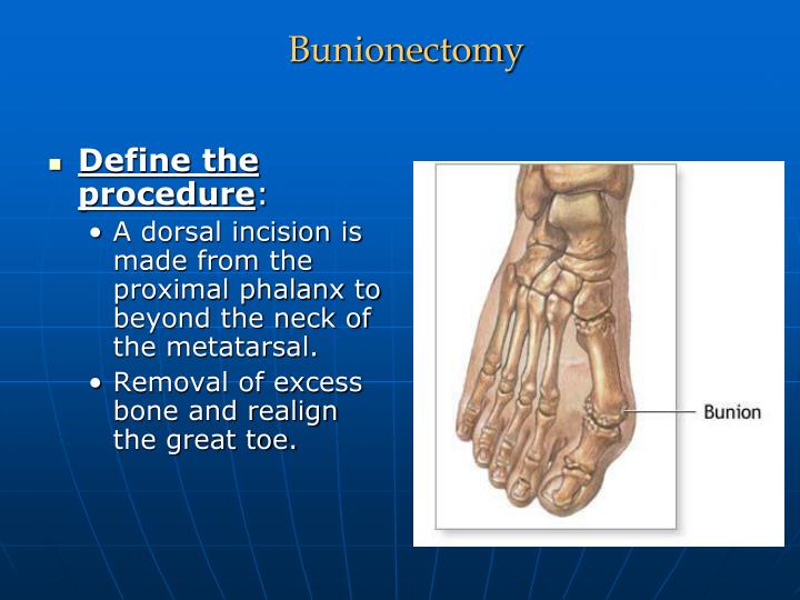 PPT - Bunionectomy PowerPoint Presentation - ID:2041227