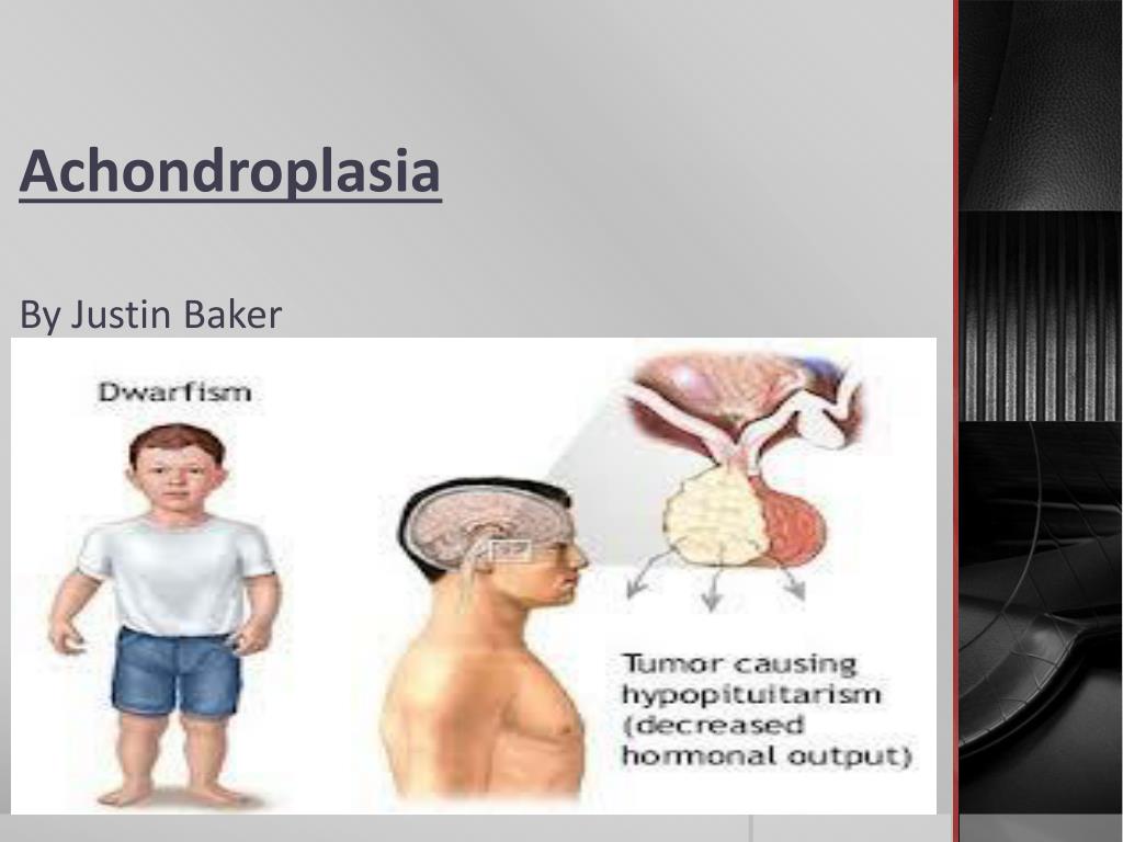 Ppt Achondroplasia By Justin Baker Powerpoint Presentation Free