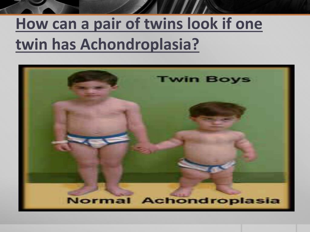 Ppt Achondroplasia By Justin Baker Powerpoint Presentation Free