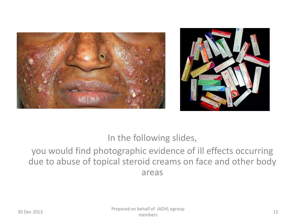 PPT - Topical steroid abuse and damaged face PowerPoint Presentation ...