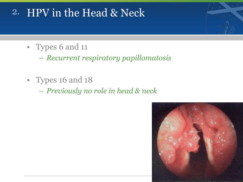 PPT - HPV Associated Oropharyngeal Cancer PowerPoint Presentation, free ...