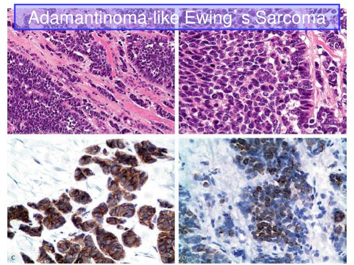 PPT - Ewing ’ s Sarcoma of Bone Differential Diagnosis PowerPoint Presentation - ID:2045458