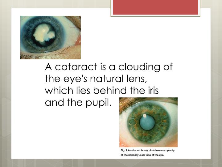 PPT - Cataract PowerPoint Presentation - ID:2046011