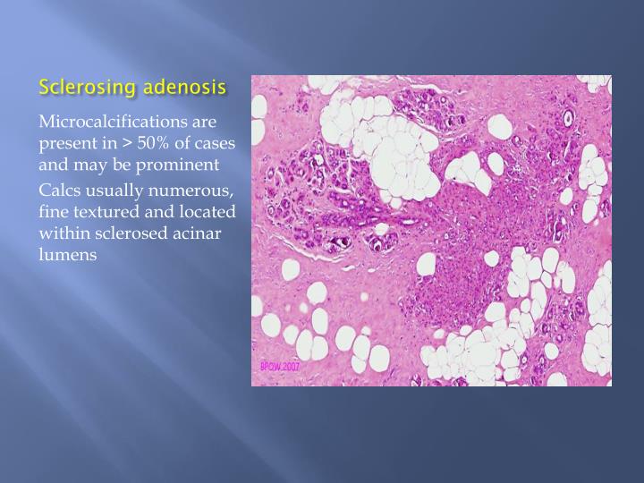 PPT - MICROCALCIFICATION IN BENIGN BREAST DISEASE PowerPoint ...