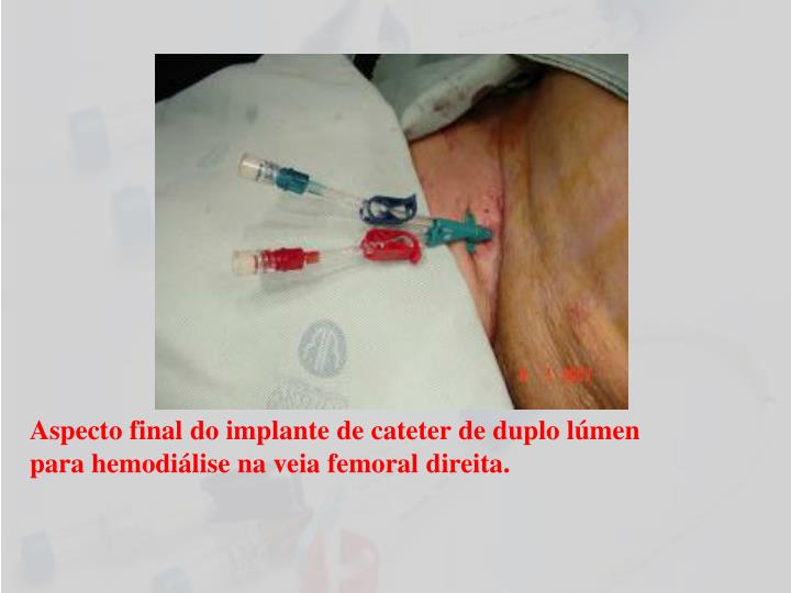 PPT - Cuidados de Enfermagem em pacientes críticos com cateter venoso ...