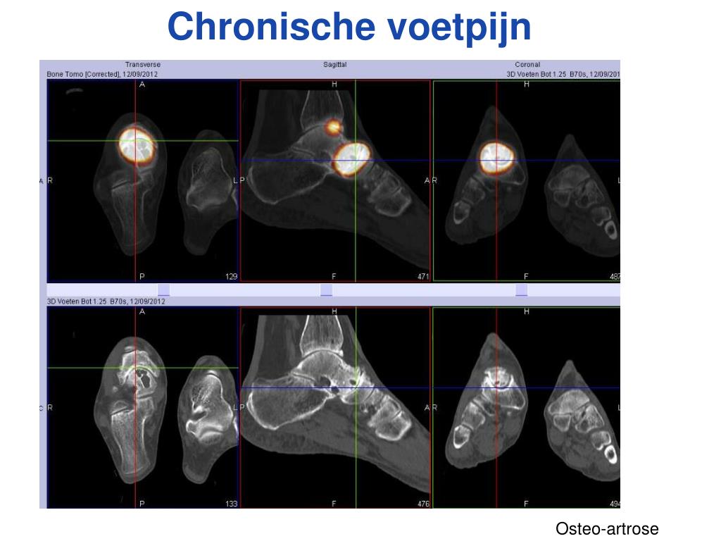 PPT - Meerwaarde van SPECT-CT bij skeletscintigrafie PowerPoint ...