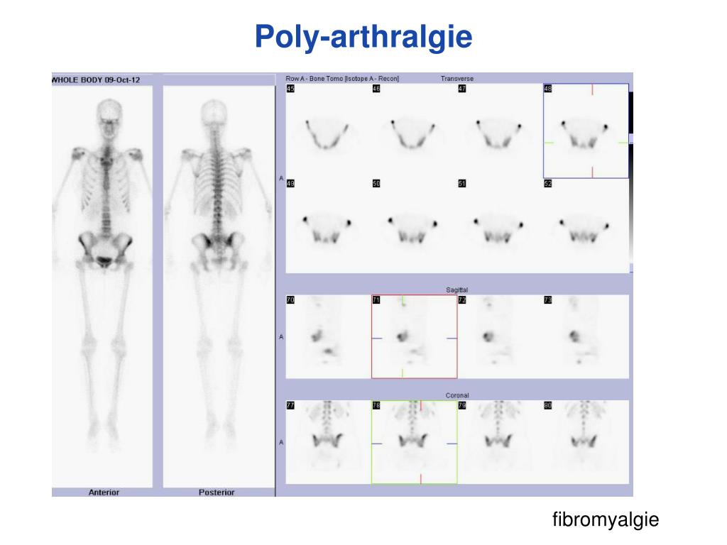 PPT - Meerwaarde van SPECT-CT bij skeletscintigrafie PowerPoint ...