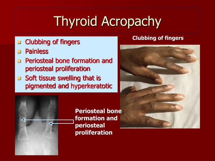 PPT - Thyroid Anatomy PowerPoint Presentation - ID:2047550