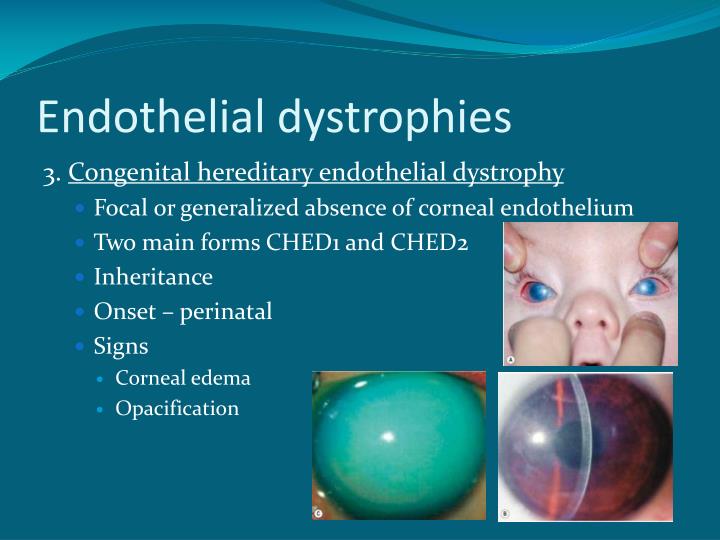 PPT - Corneal dystrophies PowerPoint Presentation - ID:2047892