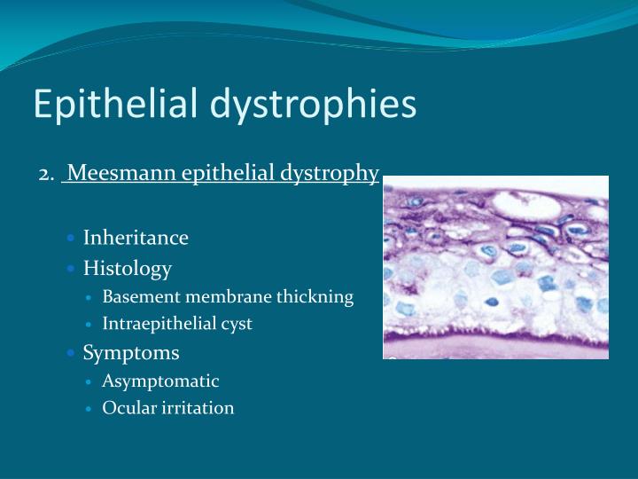 PPT - Corneal dystrophies PowerPoint Presentation - ID:2047892