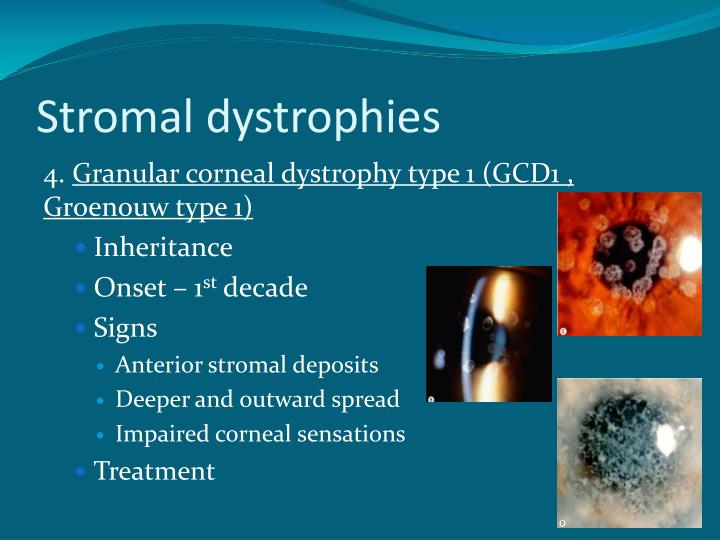 PPT - Corneal dystrophies PowerPoint Presentation - ID:2047892