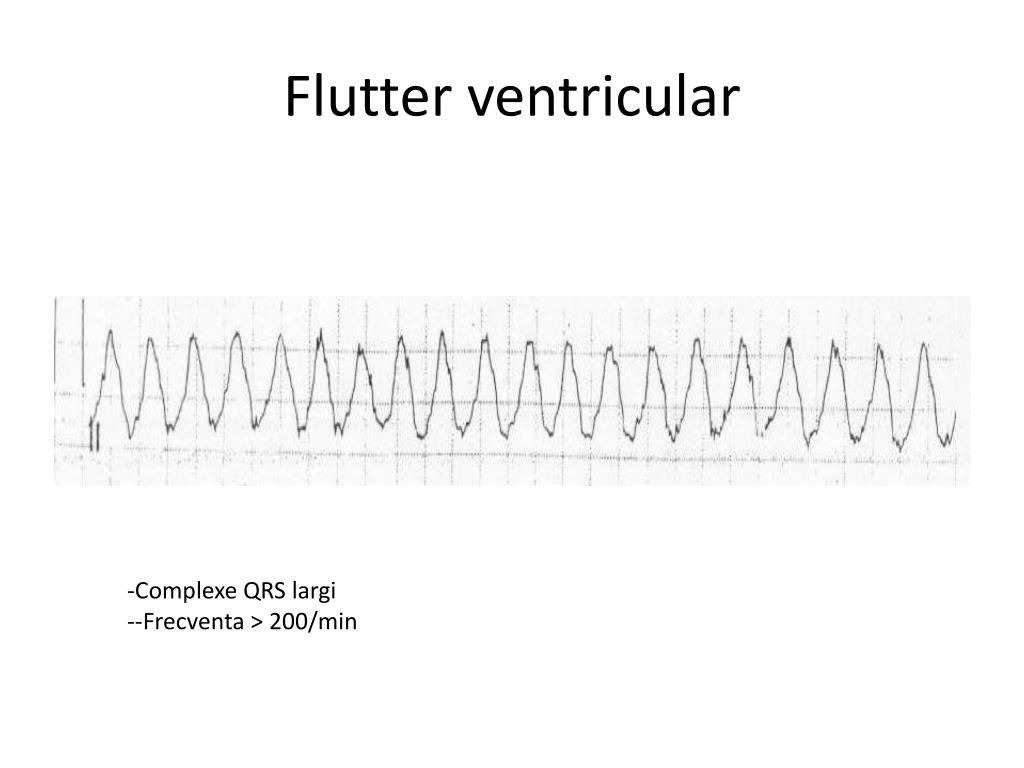 PPT - Aritmiile ventriculare PowerPoint Presentation, free download ...