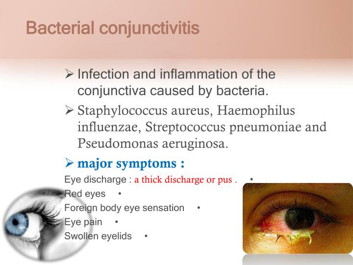 PPT - Eye infection PowerPoint Presentation - ID:2049121
