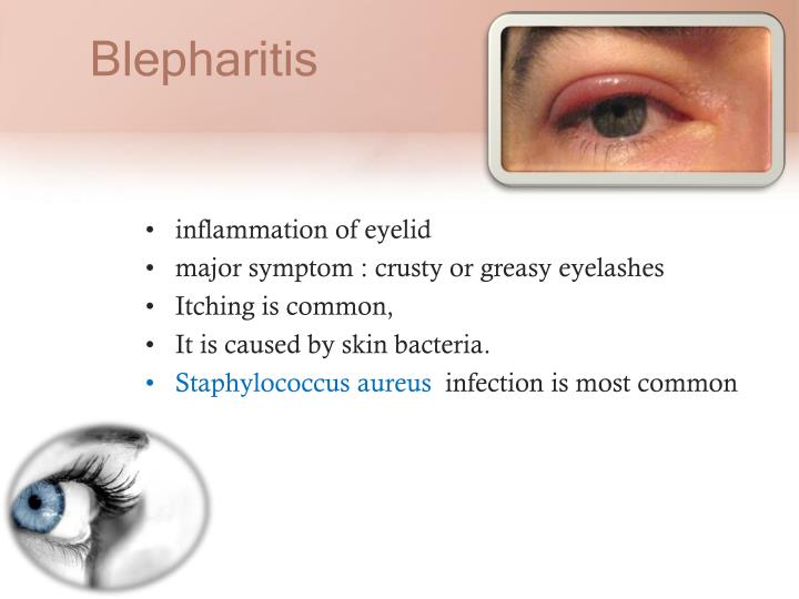 PPT - Eye infection PowerPoint Presentation - ID:2049121