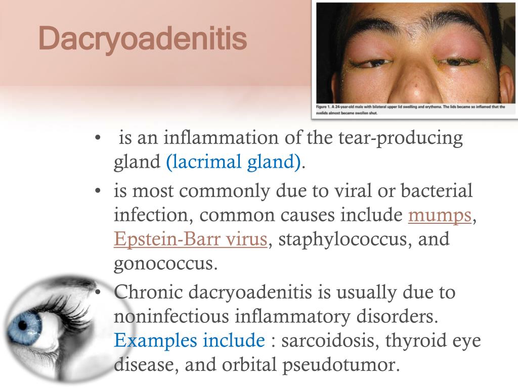 PPT Eye Infection PowerPoint Presentation Free Download ID 2049121
