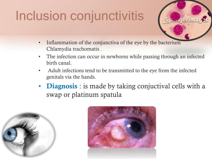 PPT - Eye infection PowerPoint Presentation - ID:2049121