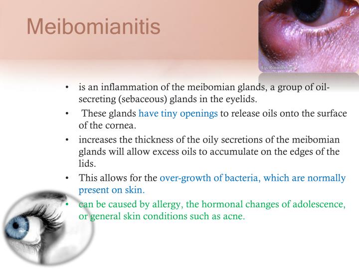 PPT - Eye infection PowerPoint Presentation - ID:2049121