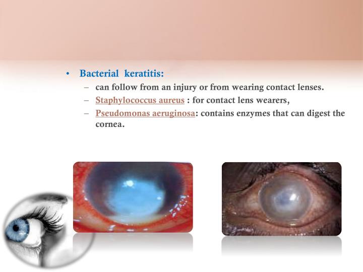 PPT - Eye infection PowerPoint Presentation - ID:2049121