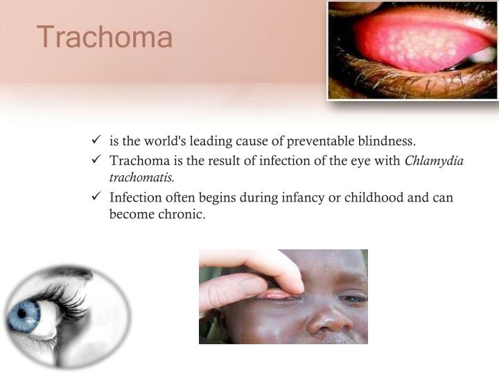 PPT - Eye infection PowerPoint Presentation - ID:2049121