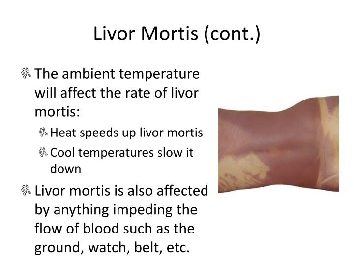 Livor Mortis Definition And Diagnosis