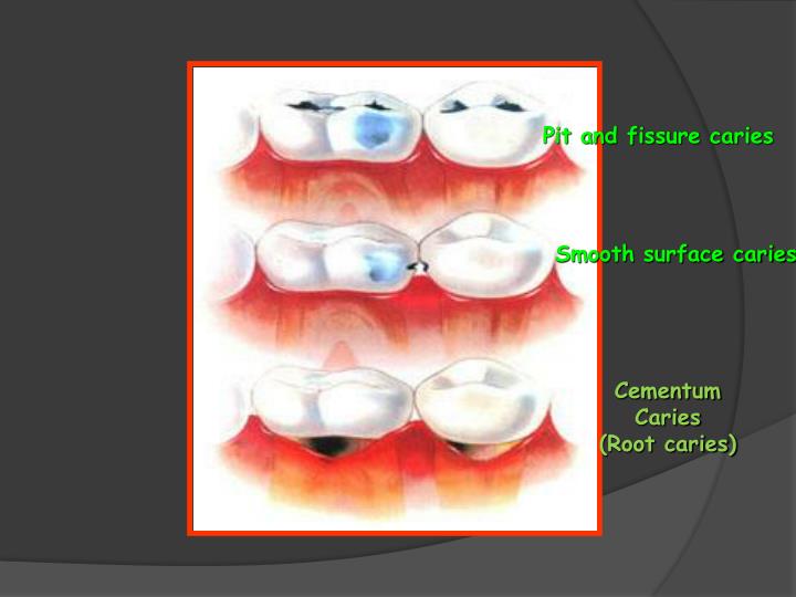 PPT - Histopathology of Dental Caries PowerPoint Presentation - ID:2053621
