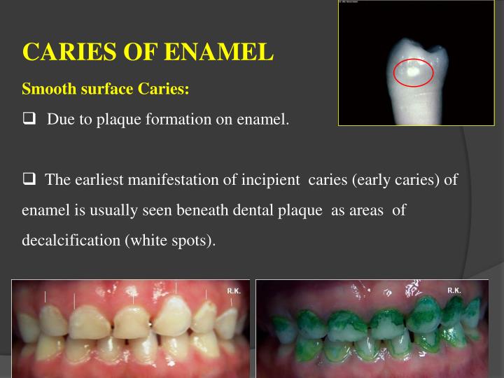 PPT - Histopathology of Dental Caries PowerPoint Presentation - ID:2053621