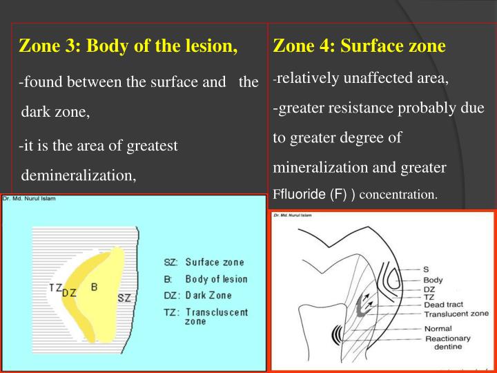 PPT - Histopathology of Dental Caries PowerPoint Presentation - ID:2053621
