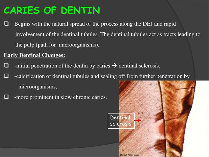 PPT - Histopathology of Dental Caries PowerPoint Presentation - ID:2053621