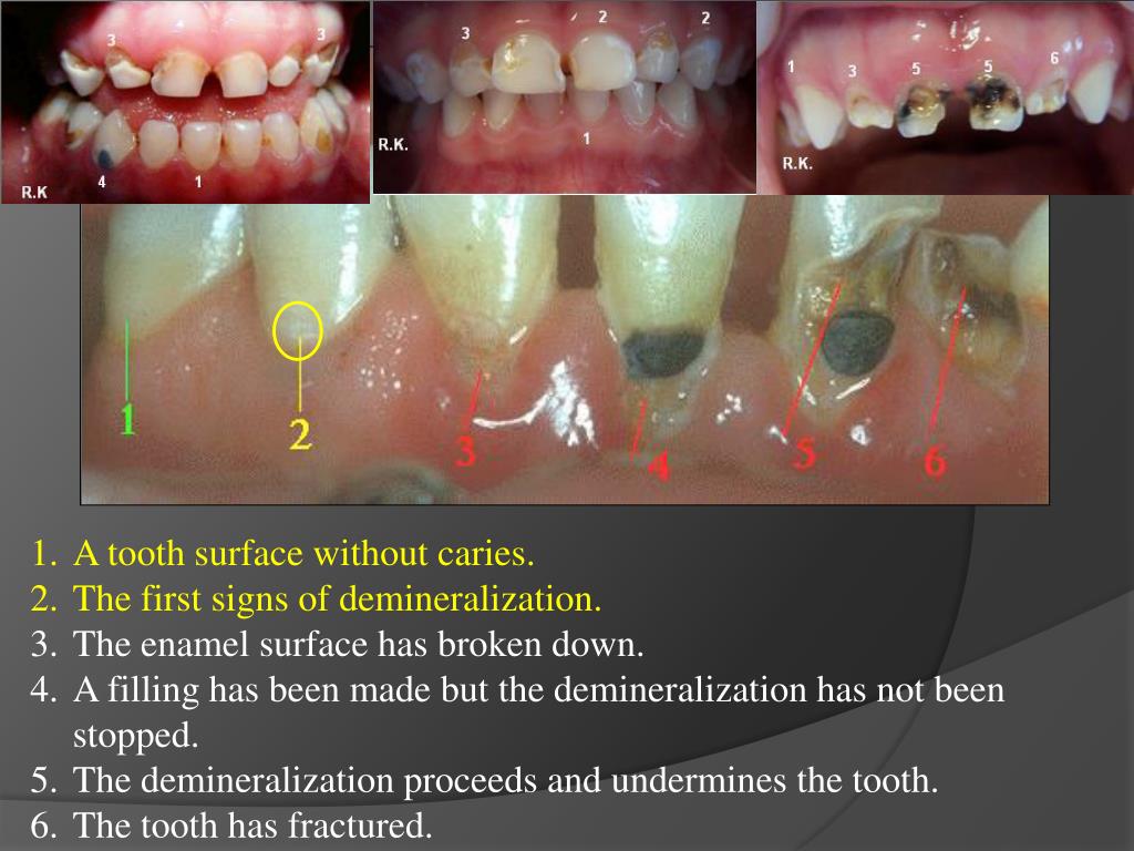 Ppt Histopathology Of Dental Caries Powerpoint Presentation Free The