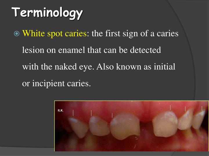 PPT - Histopathology of Dental Caries PowerPoint Presentation - ID:2053621