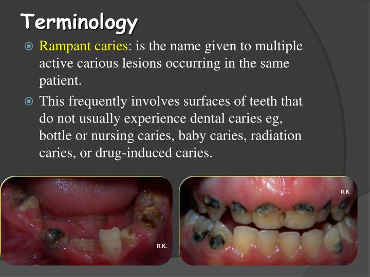 PPT - Histopathology of Dental Caries PowerPoint Presentation - ID:2053621