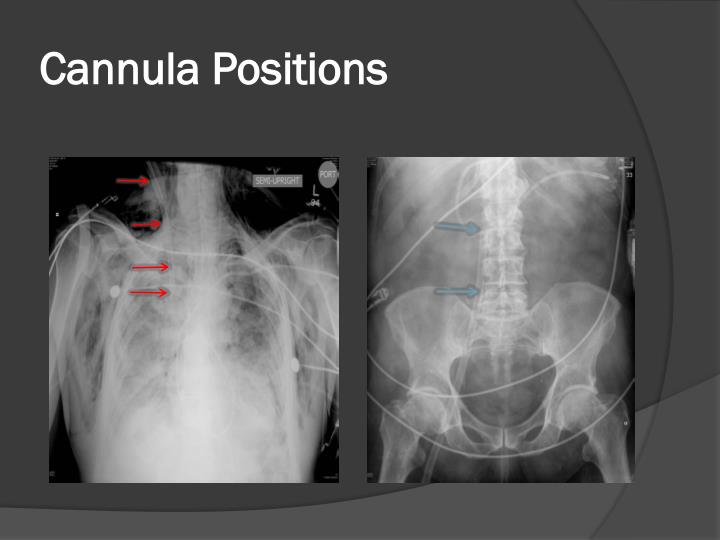 PPT - ECMO and the Adult Patient: Nursing considerations PowerPoint ...
