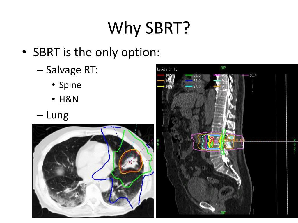 PPT - Yoshiya (Josh) Yamada MD FRCPC Department of Radiation Oncology ...