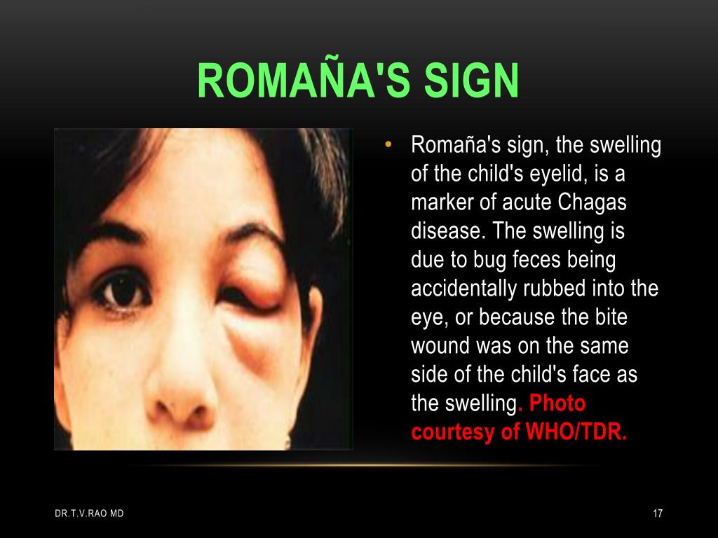 PPT - Trypanosoma cruzi Chagas’ Disease PowerPoint Presentation, free ...