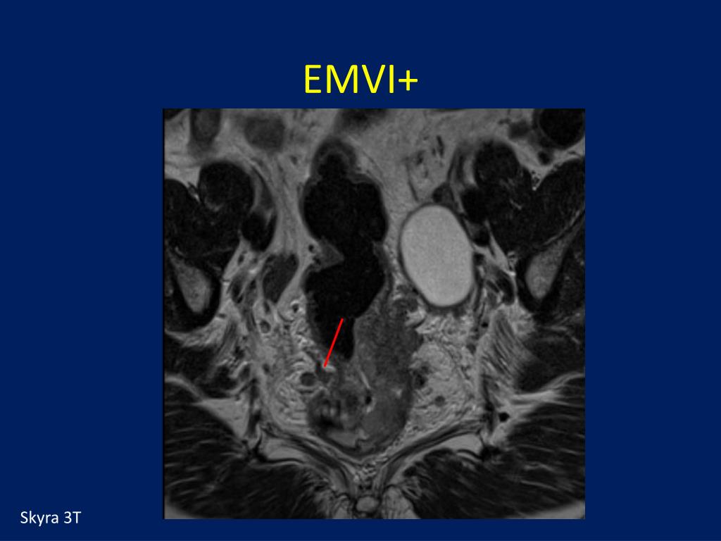 PPT - Lokal bedömning av rectalcancer med MRT PowerPoint Presentation ...