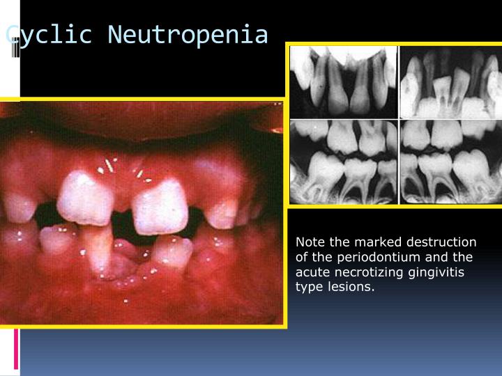 PPT - Periodontitis as a manifestation of systemic diseases PowerPoint ...