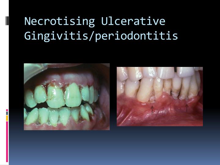 PPT - Periodontitis as a manifestation of systemic diseases PowerPoint ...