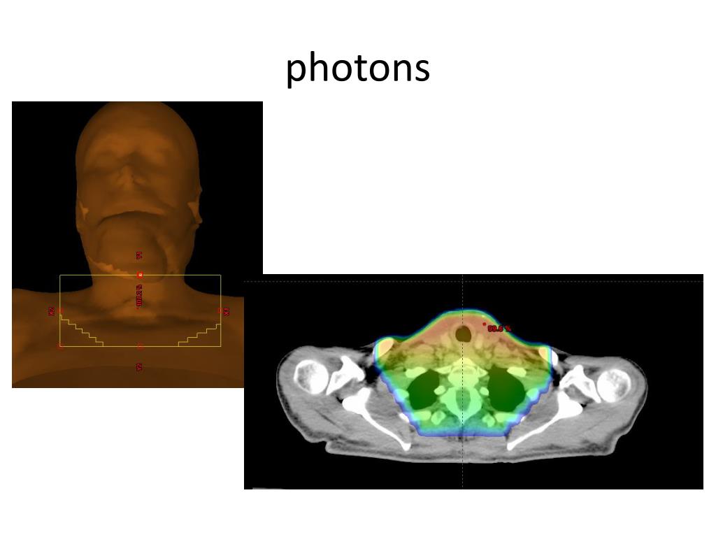 PPT - radiation therapy in cancers of the head and neck PowerPoint ...
