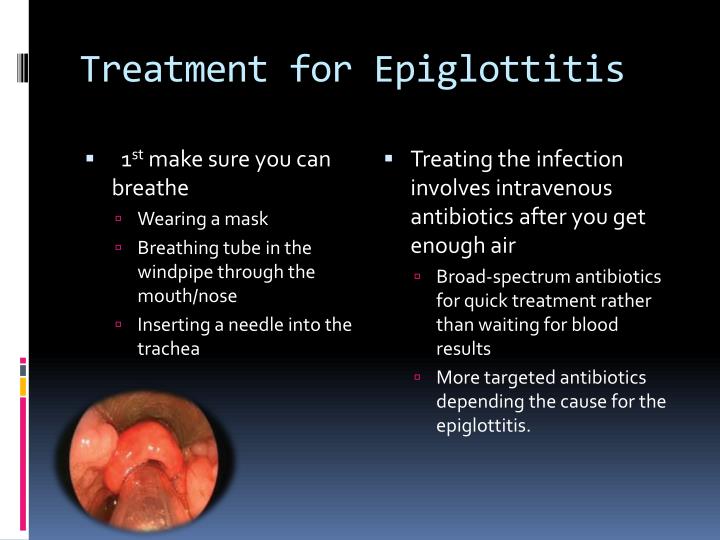 Epiglottitis Cks