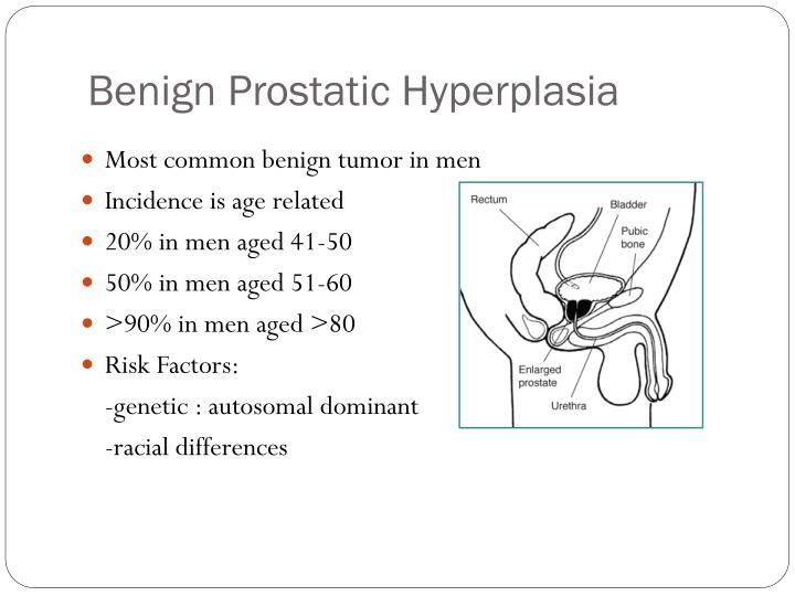 PPT - Neoplasms of the Prostate Gland PowerPoint Presentation - ID:2063288