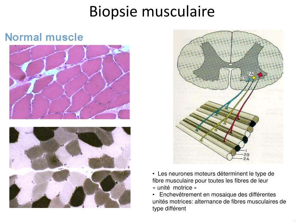 PPT - Maladies Musculaires Et Myasthenie Grave Pierre Bourque ...