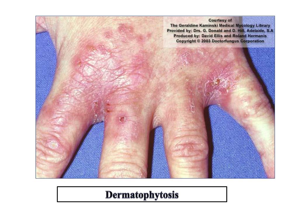 PPT - Medical Mycology PowerPoint Presentation, free download - ID:2067414