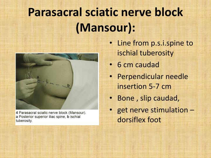 PPT - Sciatic nerve block PowerPoint Presentation - ID:2074459